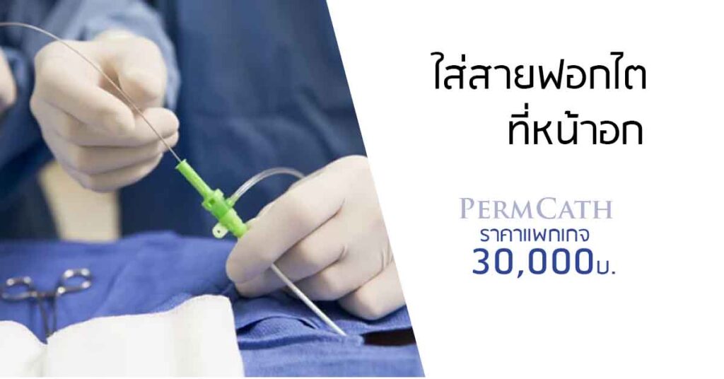 วางสายฟอกไตที่หน้าอก กึ่งถาวรPERM CATH