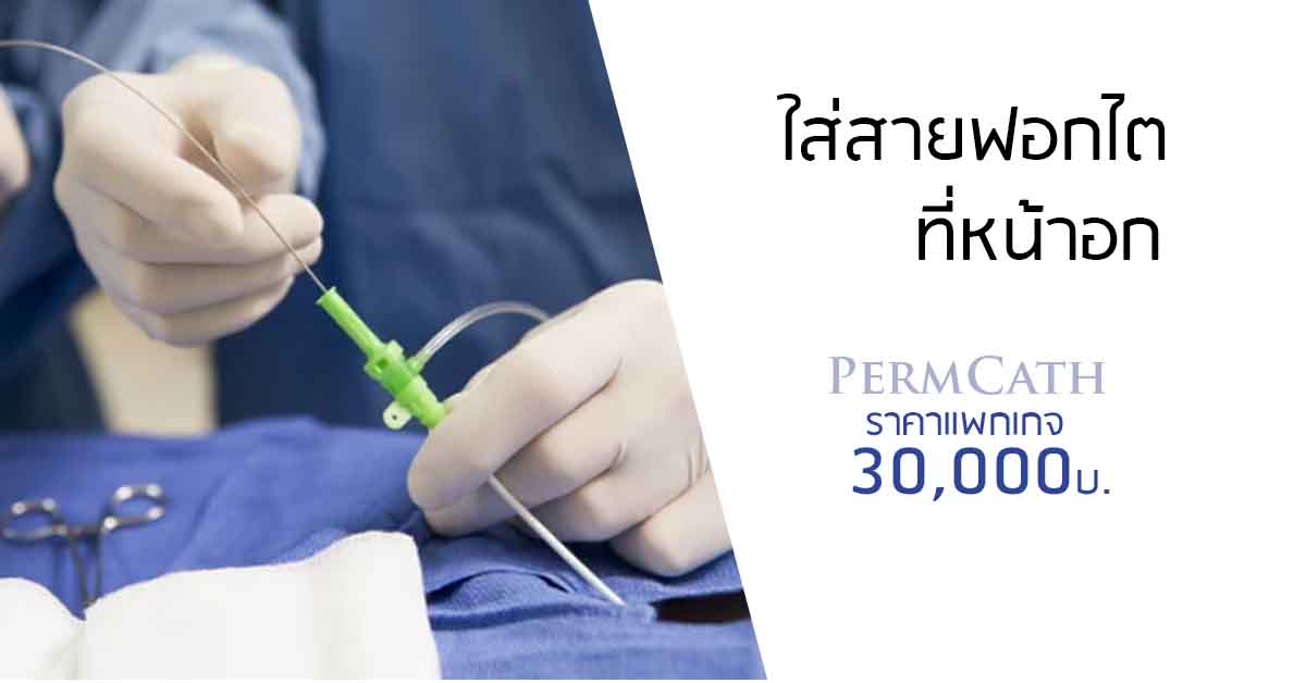วางสายฟอกไตที่หน้าอก กึ่งถาวรPERM CATH